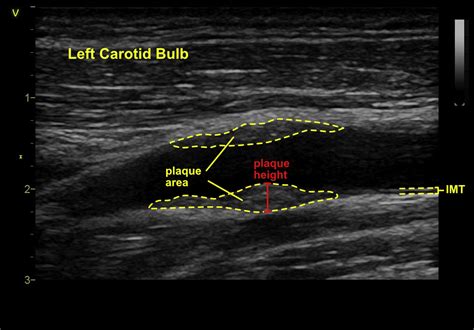 Recommendations For The Assessment Of Carotid Arterial Plaque By Ultrasound For The