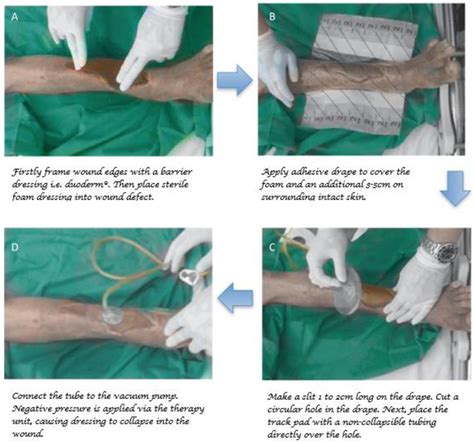Application Of Npwt Dressing Download Scientific Diagram