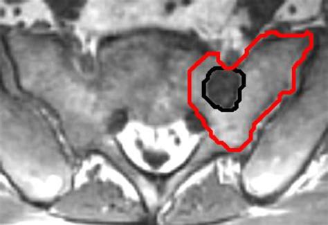 Stereotactic Body Radiation Therapy For Sacral Metastases Deviation