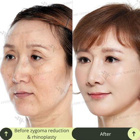 Cheek Bone Zygomatic Reduction South Korea From Aud75week Glamjet