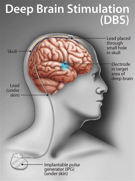 Deep Brain Stimulation | HealthPlexus.net
