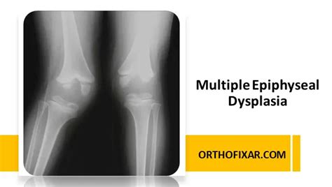 Pediatric Lateral Condyle Fractures Diagnosis Treatment And