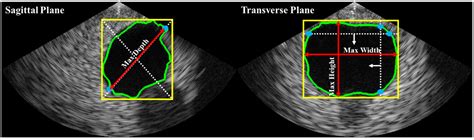 A Lightweight Deep Learning Network On A System On Chip For Wearable Ultrasound Bladder Volume