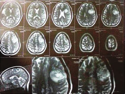 Magnetic Resonance Imaging Brain Revealing An Extra Axial Dural Based