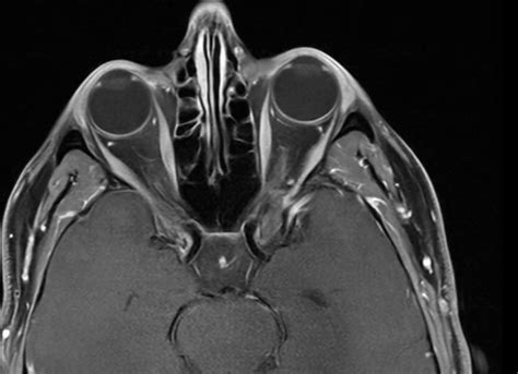 Optic Neuritis Left Eye More Views Rradiology