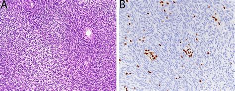 Malignant Peripheral Nerve Sheath Tumor Is A Fascicular Spindle Cell Download Scientific