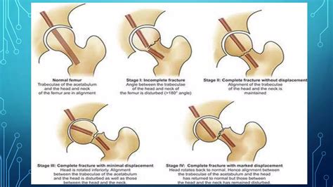 Neck Of Femur Fracture Pptx