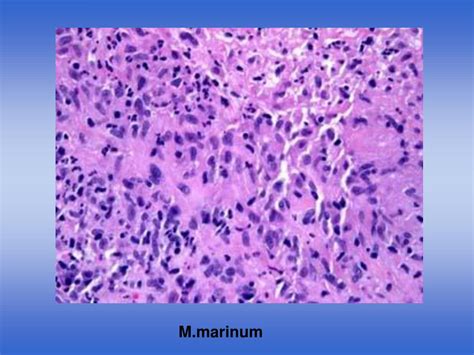 Mycobacterium Marinum Treatment Antibiotic