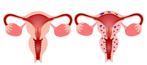 Adenomyosis Symptoms Treatment