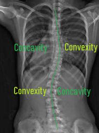 Concave Vs Convex Spine