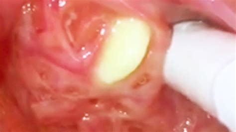 Tonsil Stone Removal Best Of Tonsilloliths Youtube