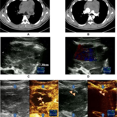 Viable Targeting Ultrasound Guided Core Needle Biopsy For A 28 Year Old