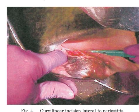 Figure 4 From Surgical Removal Of Mandibular Periostitis Bone Spurs