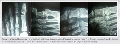 Irreducible Dislocation Of The Great Toe Interphalangeal Joint Dorsal And Plantar Management