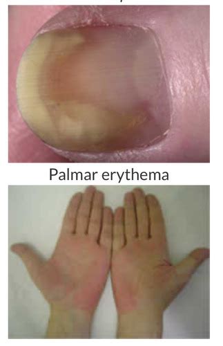 Assessment Of The Thyoid Gland Flashcards Quizlet