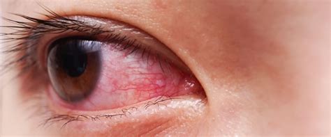 Red Eye Symptoms And Treatment