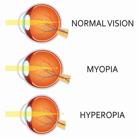 Eyesight Defects Illustrations Royalty Free Vector Graphics And Clip Art