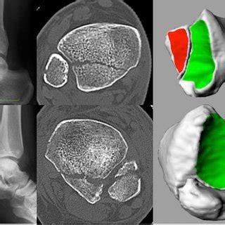 Pdf Posterior Malleolar Fracture Patterns