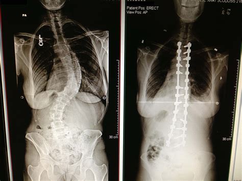 Scoliosis Surgery Gone Wrong