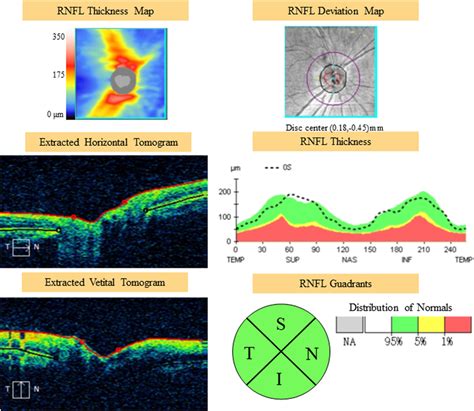 Example Of Scanning And Measurements Of Rnfl With Oct Rnfl Retinal Download Scientific