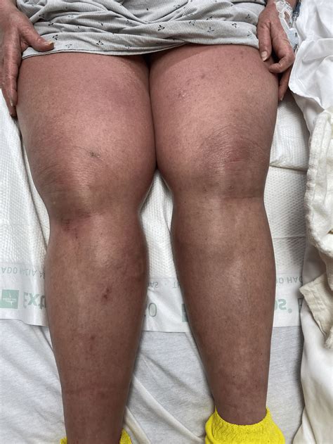 Diffuse Erythema On Bilateral Lower Extremities 6 Days Following First Download Scientific