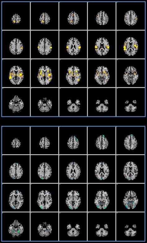 Conjunction Analysis The Upper Panel Shows The Results Of A