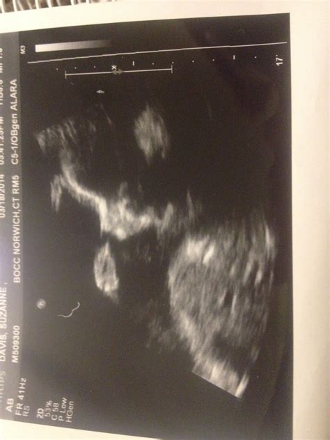 Ultrasound Archives Bebehblog