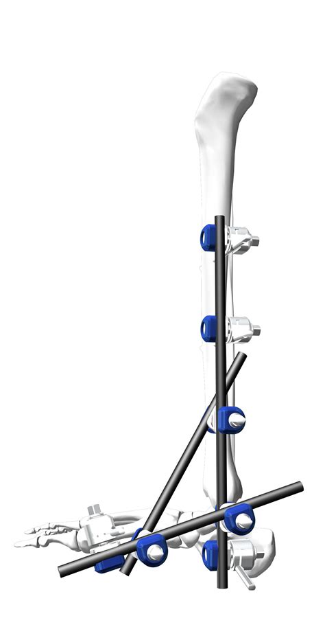 Orthopedic External Fixation System Ankle Stable Frame External