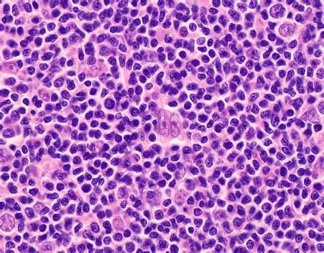 Lymphocyte Histology