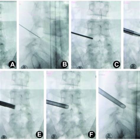 Intraoperative Fluoroscopy A The Anteroposterior Fluoroscopy After Download Scientific