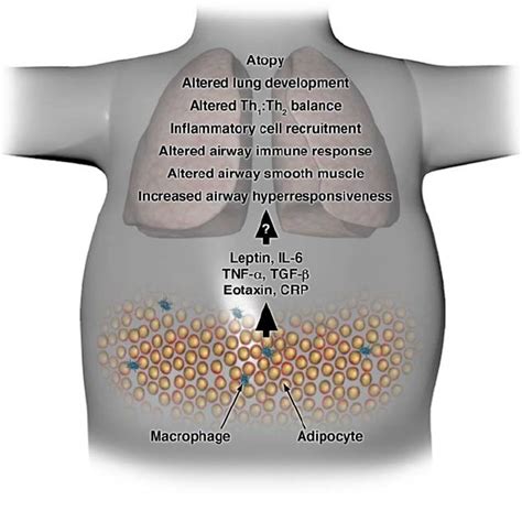Obesity Leads To Alterations Of Lung Volumes Top Particularly