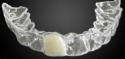 How To Add Missing Teeth To A Retainer Order