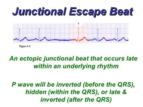 Heart Block Junctional Rhythm At Lucas Kemble Blog