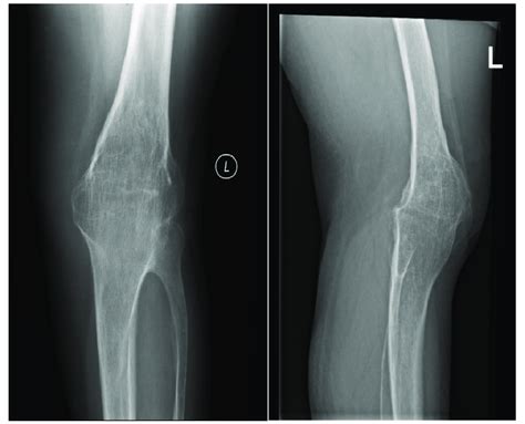 X Ray Face And Profile Of The Knee Arthrodesis Figure 2 Supine X Ray Download Scientific