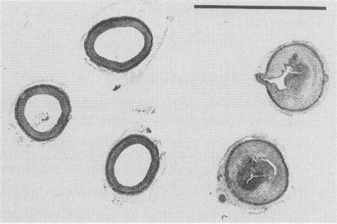 Figure 2 From The Role Of Intimal Hyperplasia In Arterial Spasm