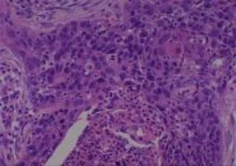 Novus Biologicals Human Multi Tissue Tissue Microarray Cancer Human Ovary Serous Cystadenoma