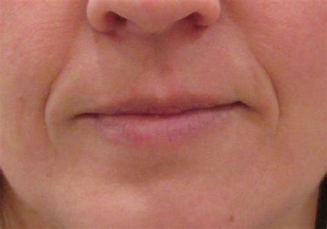 Botox Before And After 42 Sgk Plastic Surgery