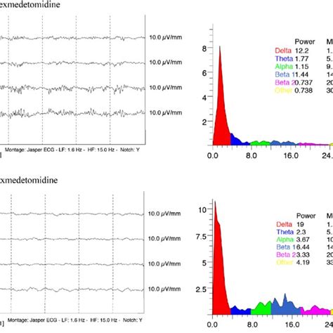 Figure Electroencephalography Eeg Tracings And Spectral Analysis A