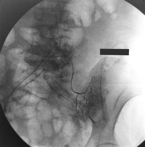 Superselective Microcoil Embolization Of Colonic Hemorrhage Ajr