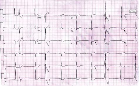 Digoxin Is Still Useful But Is Still Causing Toxicity Cleveland