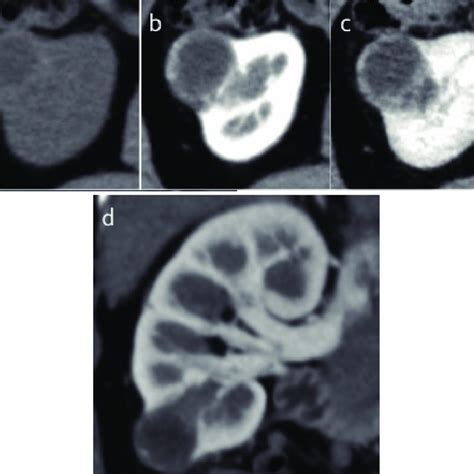 Cystic Pattern Case 12 Download Scientific Diagram