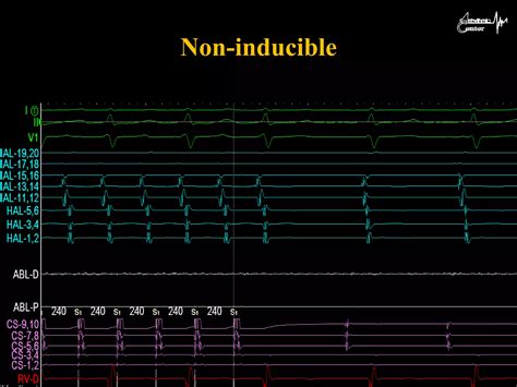 Ablation Of Atypical Flutter Pptx