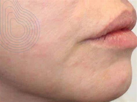 Cfu Èlife Hyperhidrosis Therapy Non Surgical Face Lift Andreduction