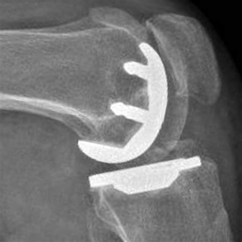 Knieteilprothese Künstliches Kniegelenk Gelenkzentrum Zürich