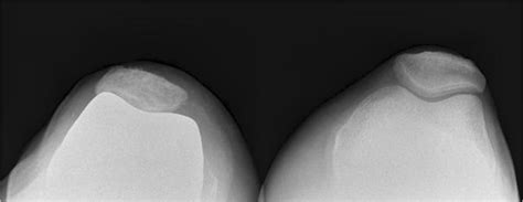 Patellar Maltracking With A Lateral Osteophyte And Increased Tilt In A