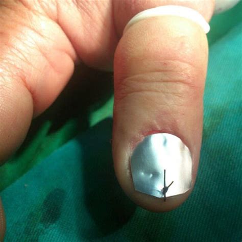 D Synthetic Nail Shield Of The Nail Bed Suture Packet Material Download Scientific Diagram