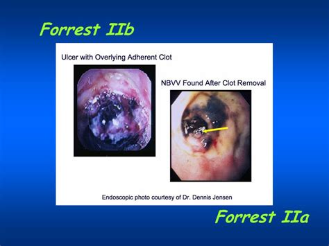 Upper Gastrointestinal Bleeding Ppt Video Online Download