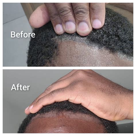 Rosemary Oil Miracle For Scalp Psoriasis Rpsoriasis Rosemary Oil Miracle For Scalp Psoriasis Rpsoriasis