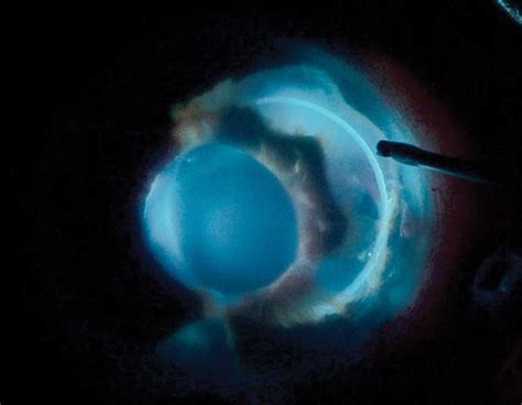 Management Of Dislocated Intraocular Lenses Retinal Physician