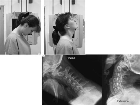 Radiography Positioning Spine Ppt Radiography Positioning Spine Ppt